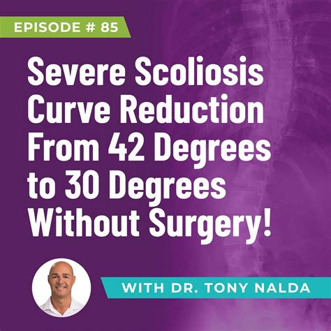 Episode 85 Severe Scoliosis Curve Reduction From 42 Degrees To 30