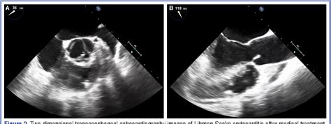 Figure 1 From Treatment Of Libman Sacks Endocarditis By Combination Of Warfarin And