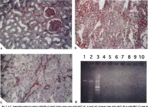 Figure 3 From Selective Loss Of Human Leukocyte Antigen Class I Allele Expression In Advanced