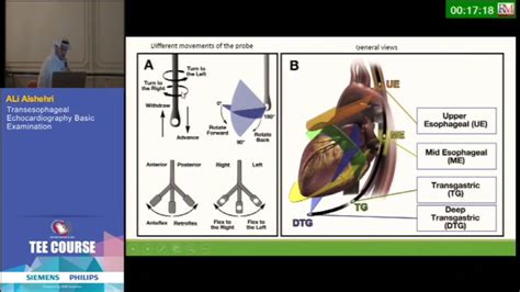 Transesophageal Echocardiogram