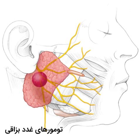 سرطان غدد بزاقی علل بروز، نشانه ها، روش تشخیص و درمان