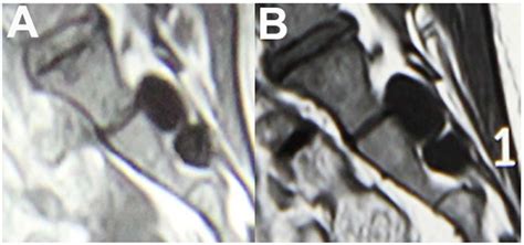 Figure 4 From Management Of Symptomatic Sacral Perineural Cysts Semantic Scholar