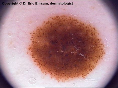 Dermoscopy Globular Pattern