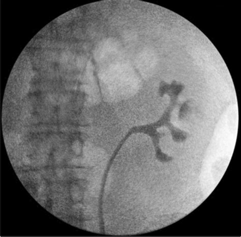 Retrograde Pyelogram Of Left Sided Collecting System Download Scientific Diagram