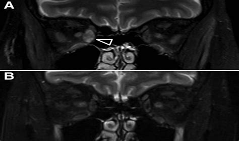 Orbital Myositis As Both A Presenting And Associated Extrain Ophthalmic Plastic