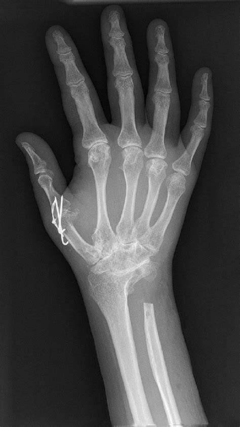 Arthrex Thumb Metacarpophalangeal Mcp Radial And Ulnar Collateral My