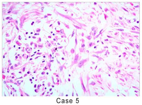 Clinicopathological Features Of Gastric Inflammatory Myofibroblastic Tumor Report Of Five Cases