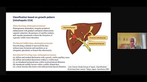 Multidisciplinary Management Of Cholangiocarcinomaintrahepatic Hilar