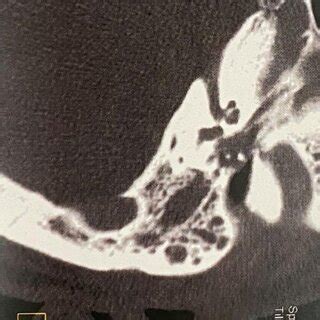 CT Of Temporal Bones Coronal Section Showing Veiling Of The Entire Download Scientific