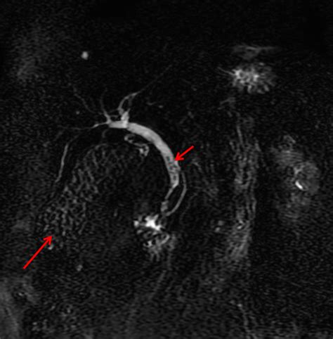 Choledocholithiasis Mrcp