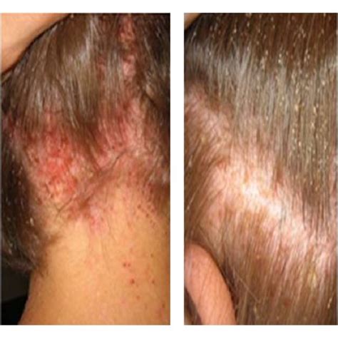 Nuisance Related To Lice A Scalp Infection Caused By Head Lice B Download Scientific