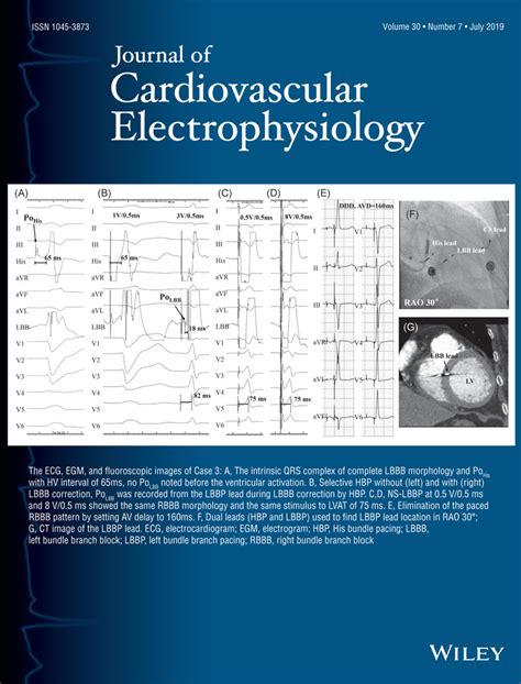 The Characteristics Of The Electrocardiogram And The Intracardiac Electrogram In Left Bundle