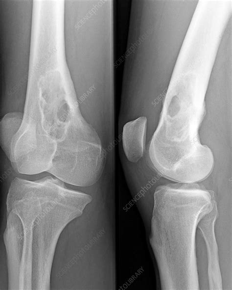 Lytic Lesion In Femur X Ray Stock Image C0436013 Science Photo
