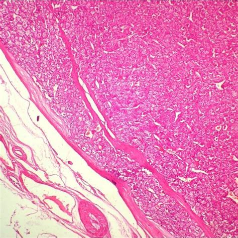 Microphotograph Showing Tumour Cells Arranged In Pallisading Pattern Download Scientific