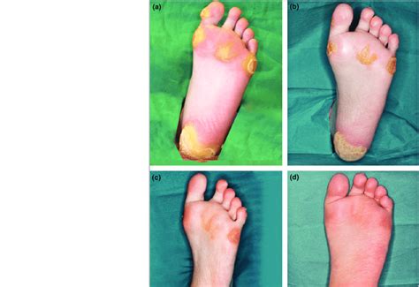 Clinical Features Of The Focal Keratoderma Of Pachyonychia Congenita Download Scientific