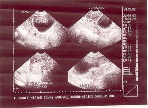 Sonogram Showing A Dermoid Cyst Download Scientific Diagram
