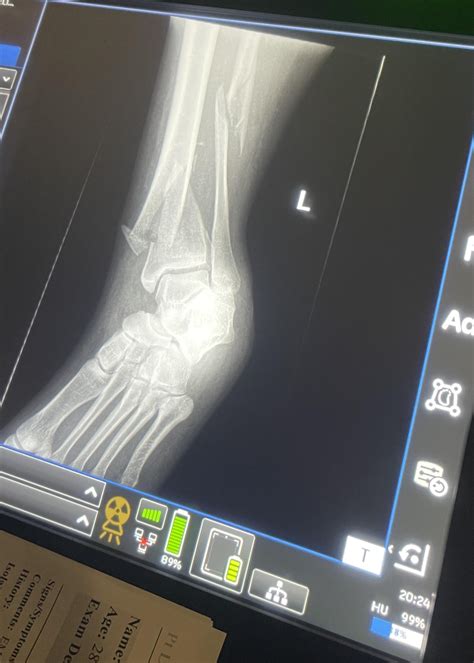 Tib Fib Break R Xrays