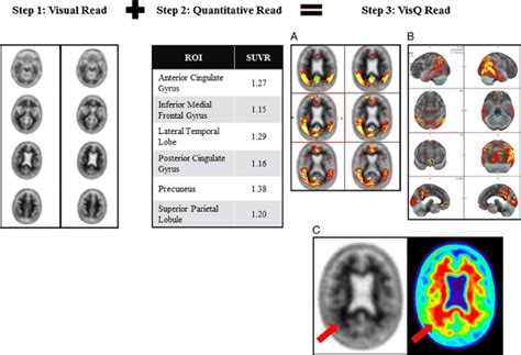 Three Step Method For Interpretation Of Florbetapir PET Scans Utilizing