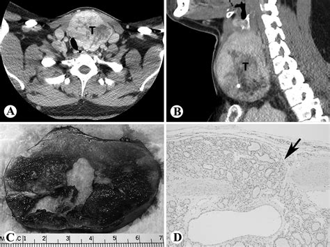 Follicular Cell Of Thyroid
