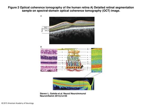 Spectral Oct Retina