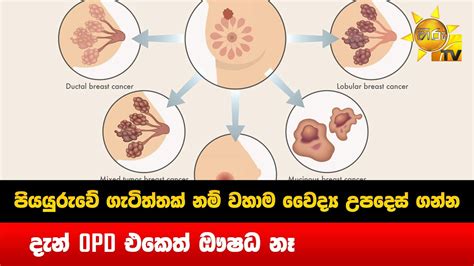 පියයුරුවේ ගැටිත්තක් නම් වහාම වෛද්‍ය උපදෙස් ගන්න දැන් Opd එකෙත් ඖෂධ නෑ Hiru News Youtube