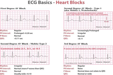 Mastering Ekg Basics Learn How To Calculate Heart Rate