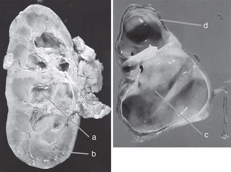 Obstructive Nephropathy Pathophysiology And Management Abdominal Key