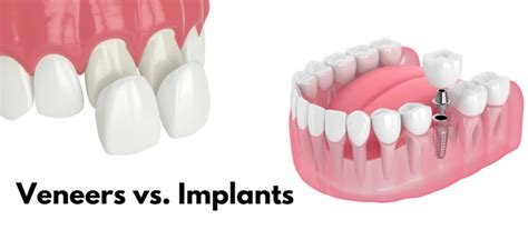 Understanding Dental Implants Vs Veneers A Guide For Patients