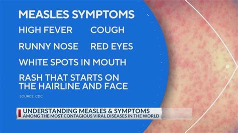 Understanding Measles Knowing Signs Symptoms