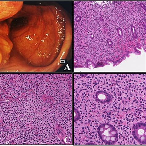 Endoscopic And Morphological Findings Of The Patient With Systemic Download Scientific Diagram