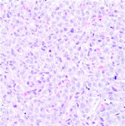 Granulocytic Sarcoma Immature Infiltrate Hematoxylin And Eosin × 500 Download Scientific
