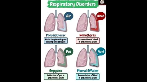 What Are The Pneumothorax Hemothorax Empyema And Pleural Effusion Youtube
