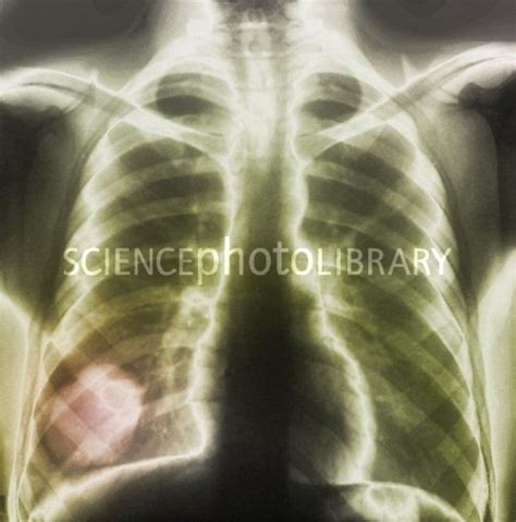 Radiographic Representation Of Lung Cyst Lung Cancer Through Various
