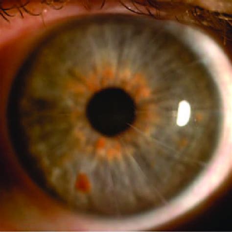 Subepithelial Fibrosis Is Visualized In The Optical Center Of The Cornea Download Scientific