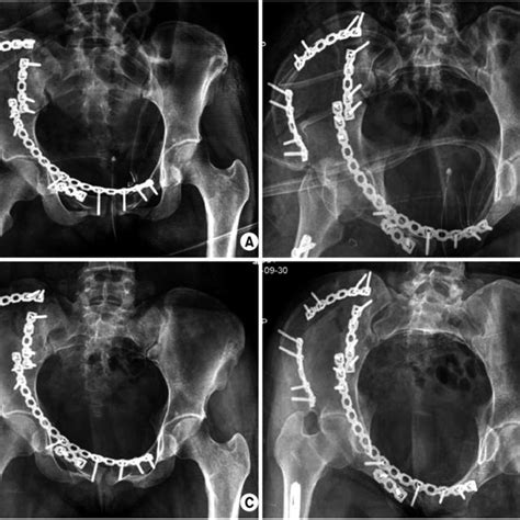 Classification Of Crescent Fracture According To Day Et Al The Download Scientific Diagram