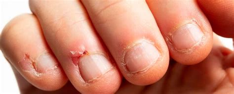 C Mo Curar Un Padrastro Infectado Blog Druni