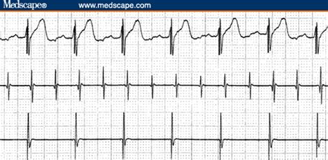 Challenges Of Atypical Atrial Flutter Ablation Werymadness