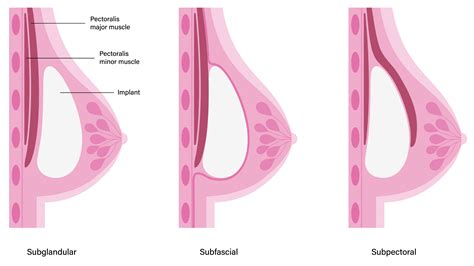Different Types Of Breast Implant Placement For Breast Augmentation