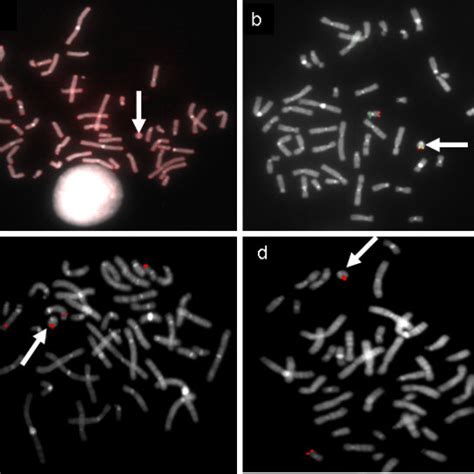 Array Cgh Chromosome 16 Profile A Genomic Imbalances On Patient Bv