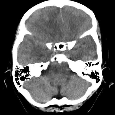 A Systematic Approach To The Interpretation Of Ct Head