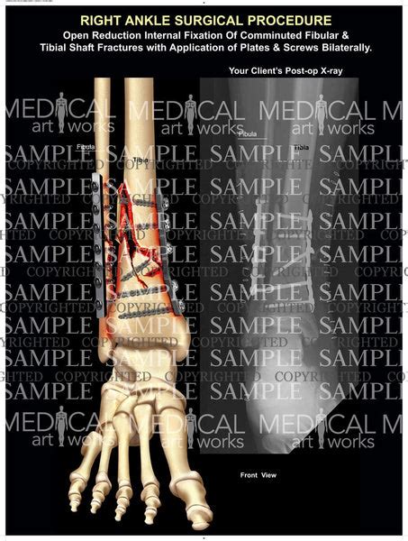 Orif Tib Fib Fracture Hardware Vinturl