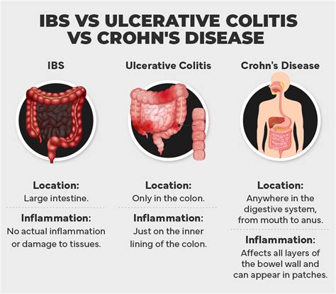 Ibs Vs Crohns Disease Vs Ulcerative Colitis Similarities And Differences Atlus