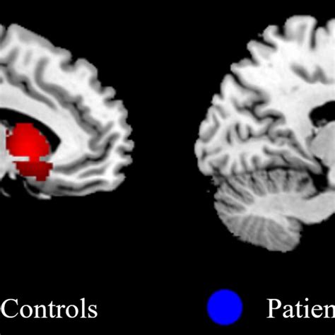 Mid‐evoked Activation Differences Between Reward Anticipation And