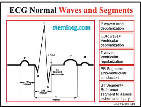 Mastering STEMI ECG