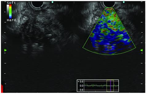 Eus Elastography Of Mass Lesion In Head Of Pancreas In Background Of