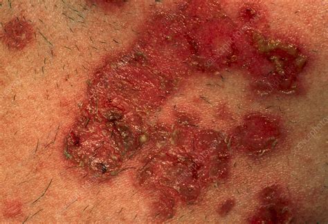 Staph Infection Rash At Ellie Lowin Blog