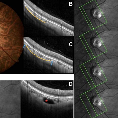 Serial OCT Sections Disclosing The Configuration Of The Posterior Download Scientific Diagram