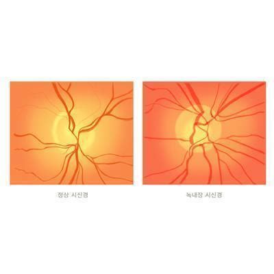 미국 Fda 안압 낮추는 안구 내 임플란트 승인 연합뉴스