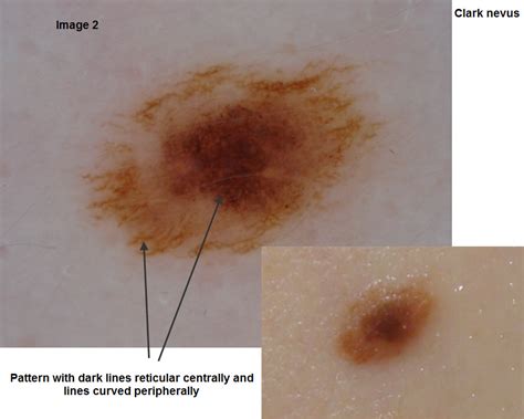 Dermoscopy Made Simple Clark Or Dysplastic Nevi