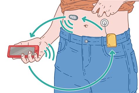 How Does An “artificial Pancreas” Work Marie Ducom Science Illustrator